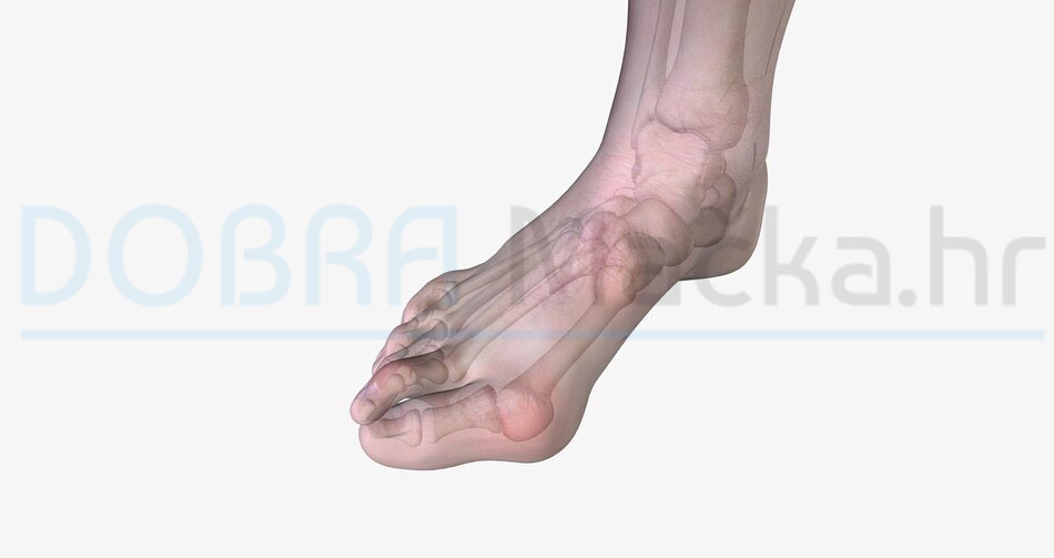 Hallux valgus ili čukalj: Kako prepoznati i liječiti / DOBRA-MACKA.HR ...