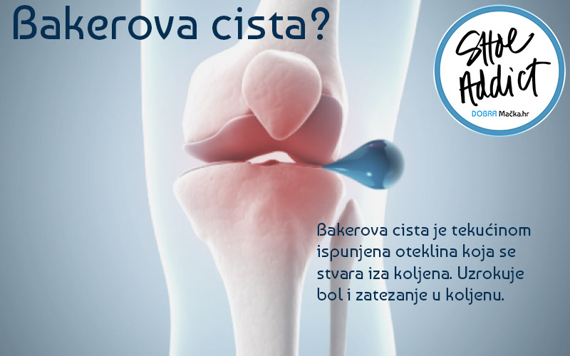 Bakerova cista: Sve što trebate znati / DOBRA-MACKA.HR - Online ...